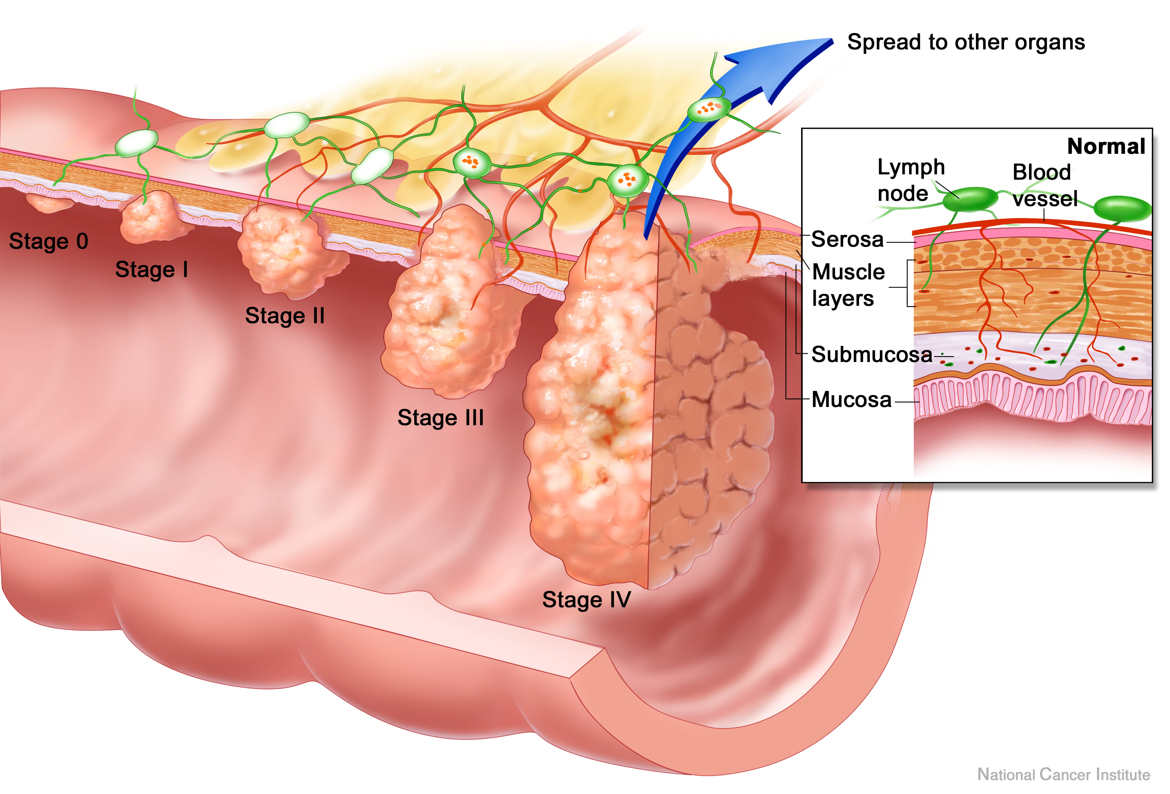 Top 10 Most Common Types Of Cancer Top 10 Most Common Types Of Cancer